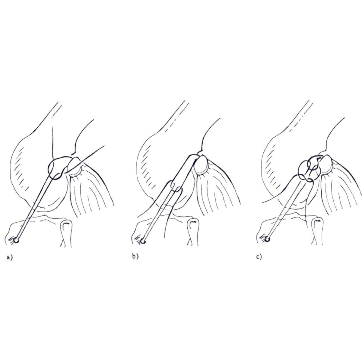 CCL Lateral Nylon Sutures – Double Strand for CrCL Surgery – Surgical ...
